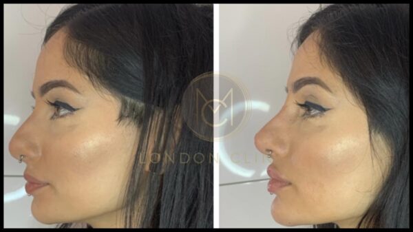 Side Profile Balancing - CM London Clinic
